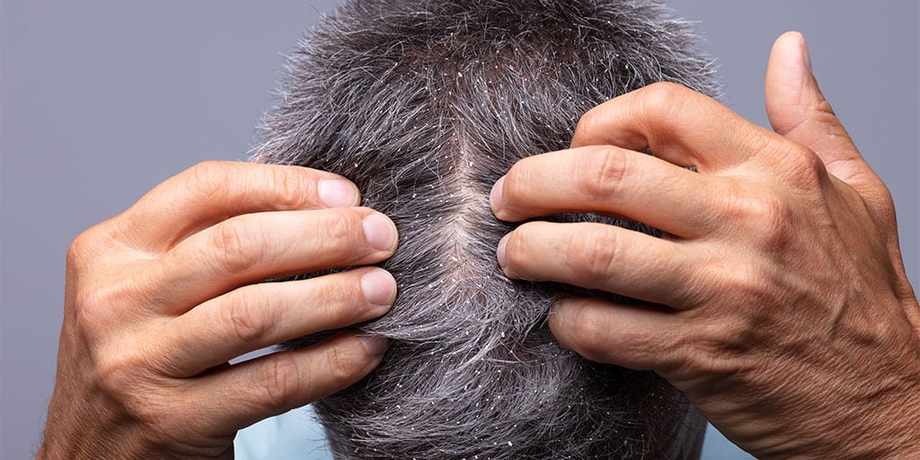 Caspas: Como surgem e como resolver | La Roche-Posay